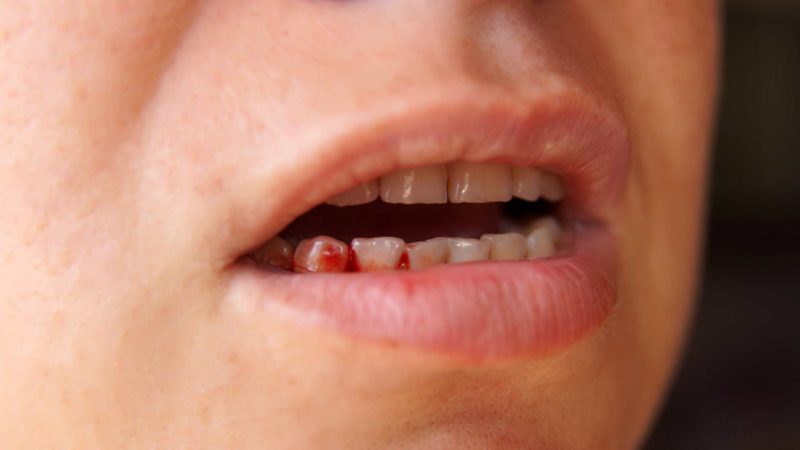 5 Signs of Micronutrient Deficiency